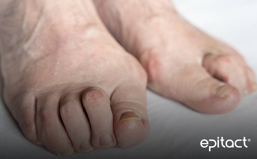 Solution pour orteil en griffe/marteau : traitement Epitact