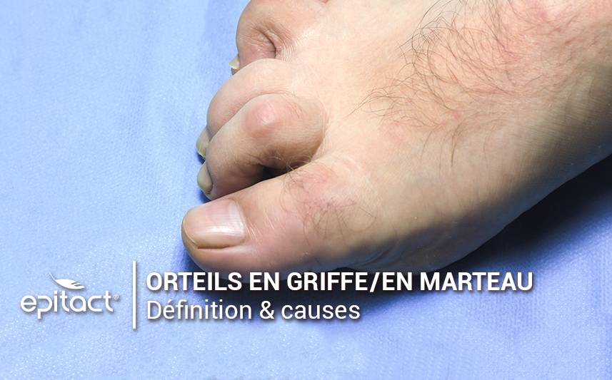 Solution pour orteil en griffe/marteau : traitement Epitact